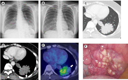 A lobulated mass in the left lower lobe: not what it seems | Thorax