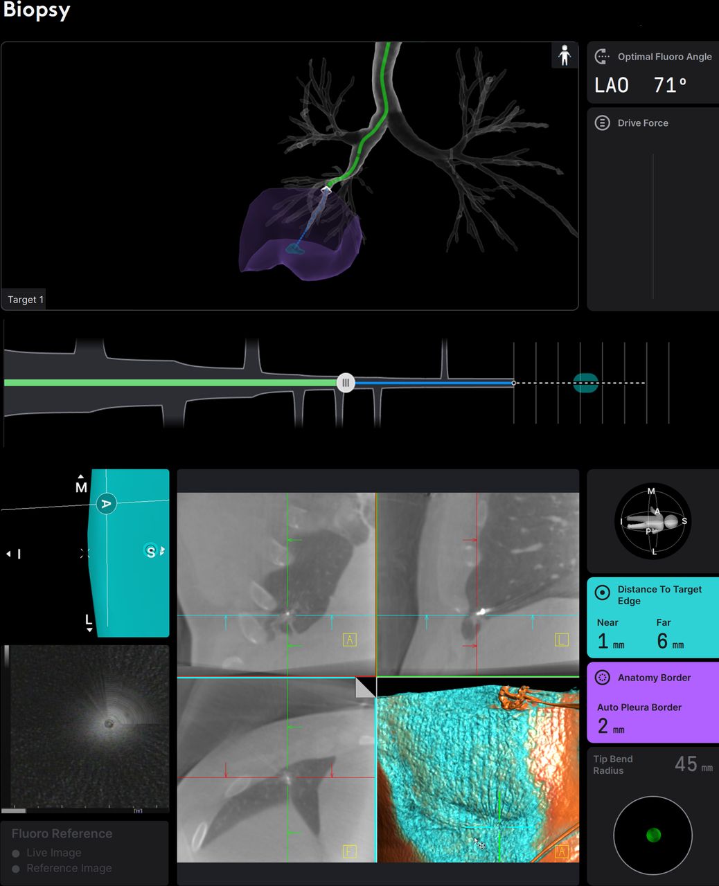 Diagnostic performance of shape-sensing robotic-assisted bronchoscopy ...