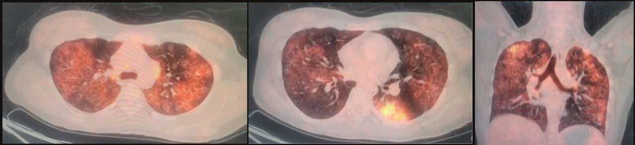 Rare case of bilateral lung nodules | Thorax