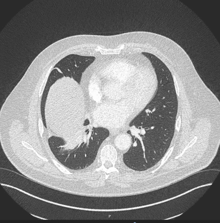 64-year-old man with a raised hemidiaphragm | Thorax