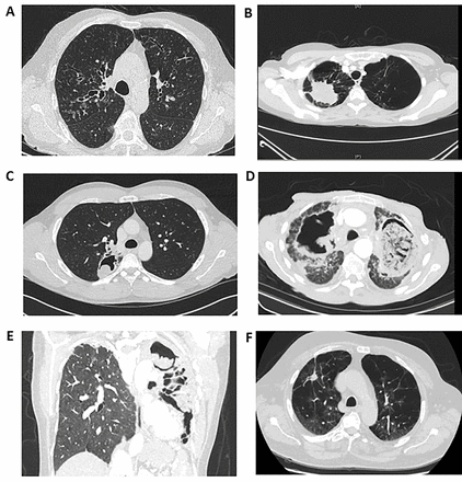 British Thoracic Society Clinical Statement on Aspergillus-related ...